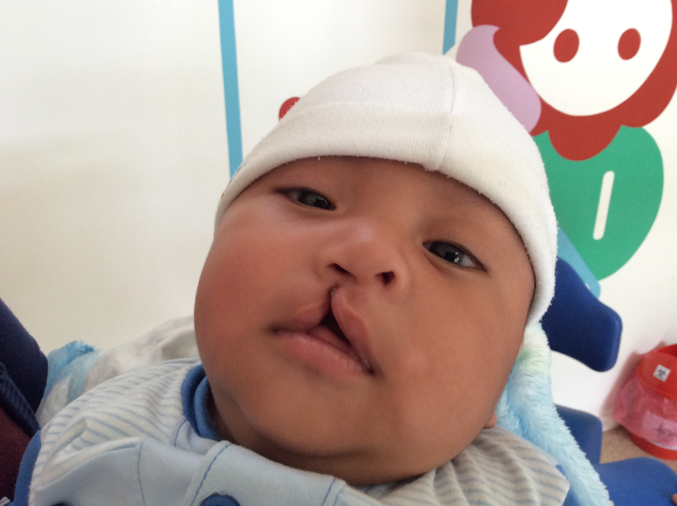 Wat is schisis (hazenlip) | Paz-Holandesa Medische hulp voor Peruaanse ...